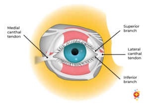 How to perform a lateral canthotomy - Don't Forget the Bubbles