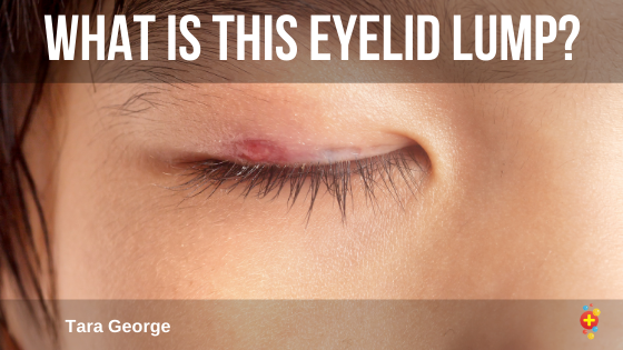 Stye or chalazion: what is it? - Don't Forget the Bubbles