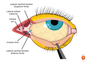 How to perform a lateral canthotomy - Don't Forget the Bubbles