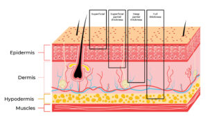 Burns Module - Don't Forget the Bubbles