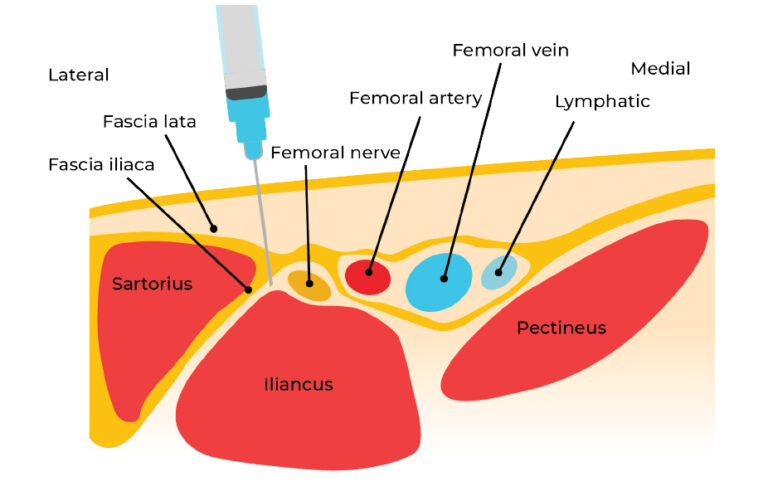 Regional Nerve Blocks Module - Don't Forget the Bubbles