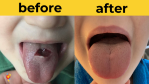 Tongue Lacerations - Don't Forget the Bubbles