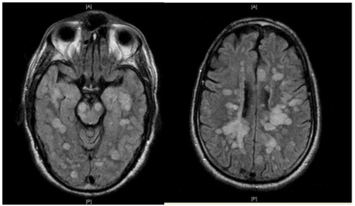 Acute disseminated encephalomyelitis (ADEM) - Don't Forget the Bubbles