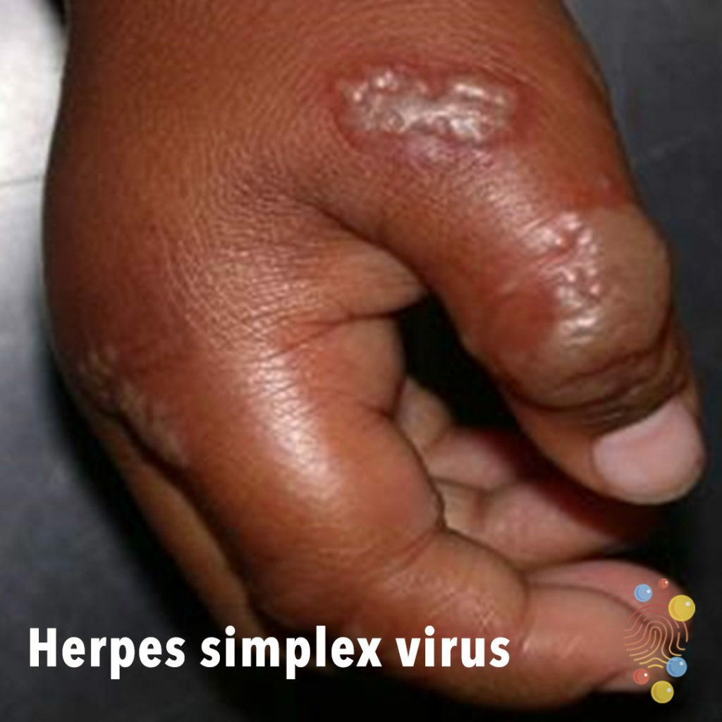 Neonatal herpes - Don't Forget the Bubbles