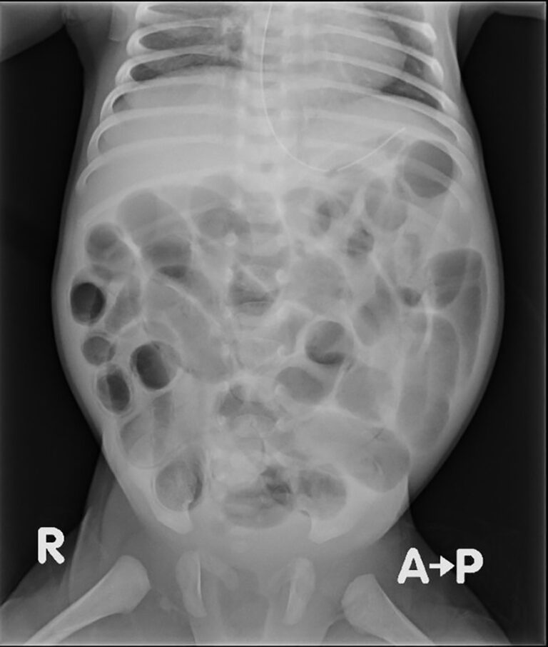 An approach to distended abdomens in neonates - Don't Forget the Bubbles
