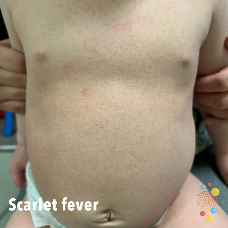 Scarlet fever - Don't Forget the Bubbles