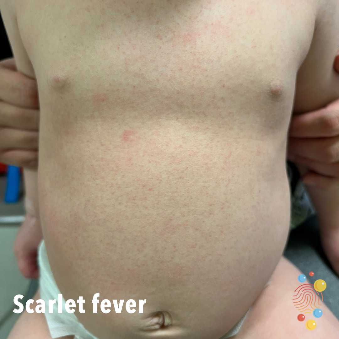 Scarlet fever - Don't Forget the Bubbles