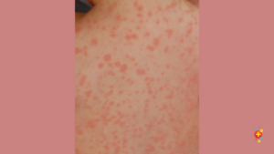 Tonsillitis - Don't Forget the Bubbles