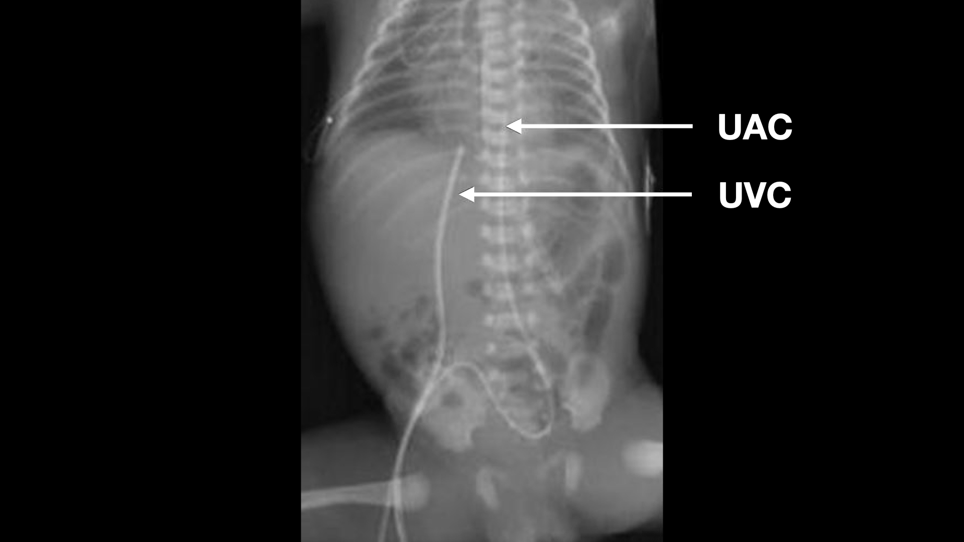 Neonatal lines and tubes - Don't Forget the Bubbles