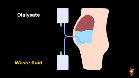 Fluid overload after cardiac surgery - Don't Forget the Bubbles