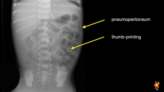 Necrotising Enterocolitis - Don't Forget the Bubbles
