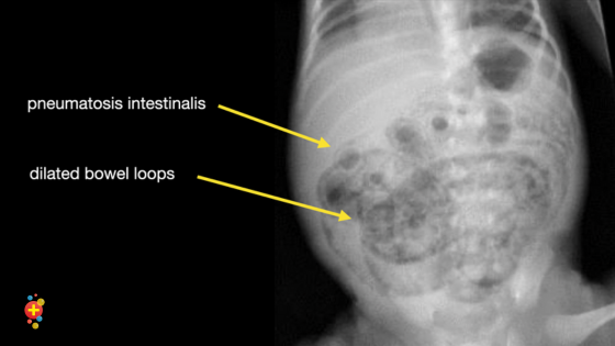 Necrotising Enterocolitis - Don't Forget the Bubbles
